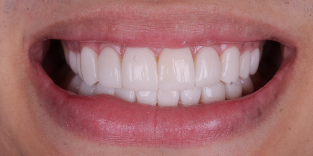 Facetas - Mappi Odontologia